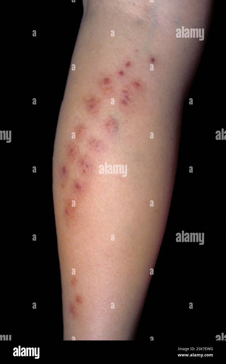 Rashes on the arm of a patient exposed to a processionary moth ...
