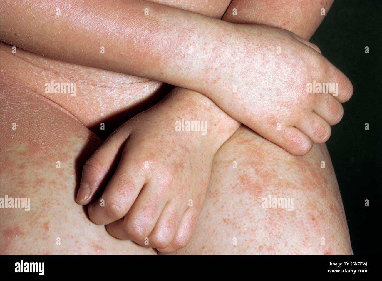 Pityriasis rubra pilaris on the thighs and hands of an 8 year old ...