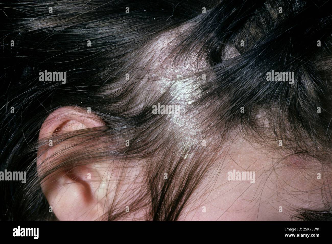Pityriasis rubra pilaris on the scalp of a 7 year old boy. Pityriasis ...