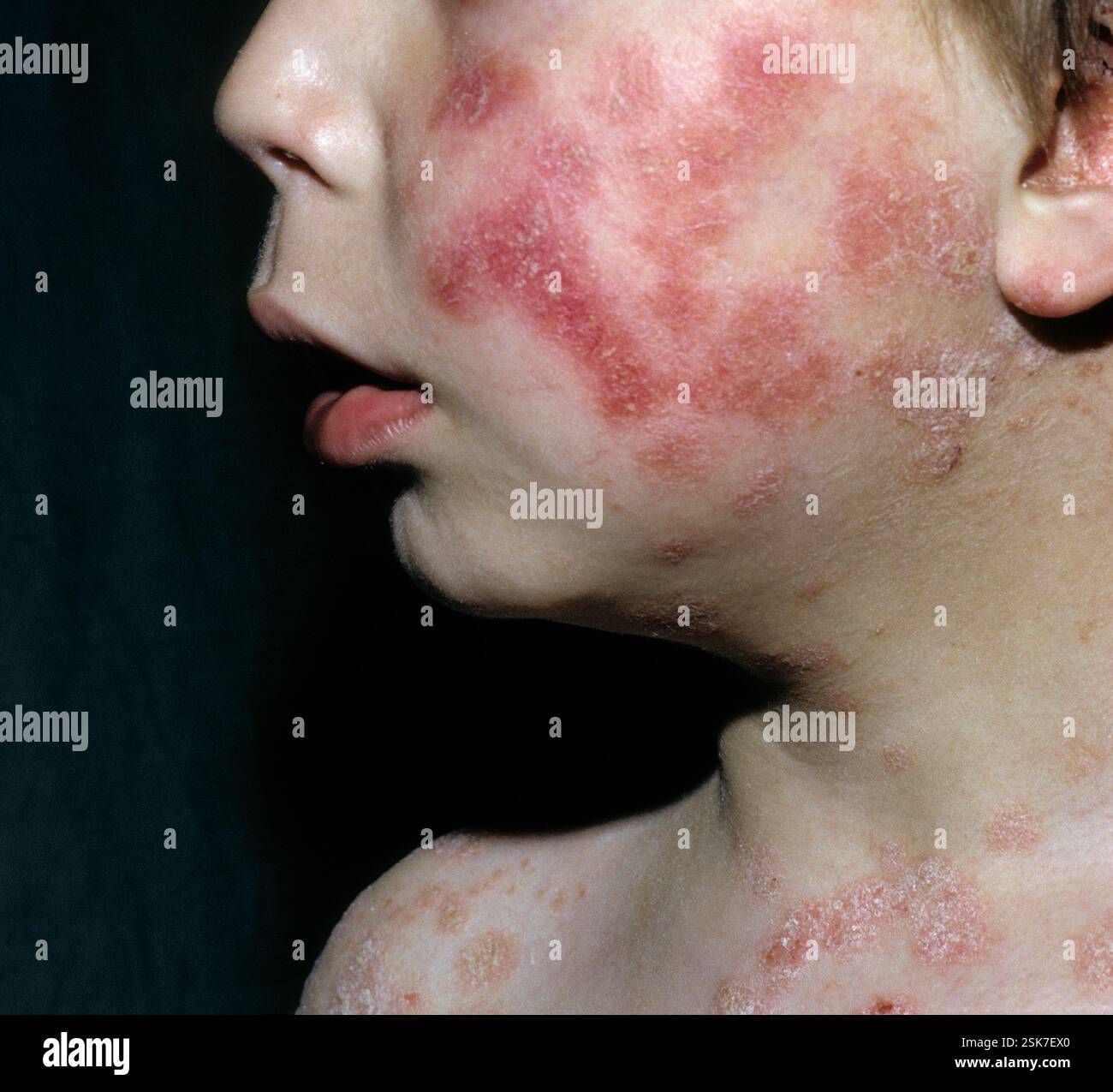 Psoriasis on the face of an eight year old boy. Psoriasis is a skin ...