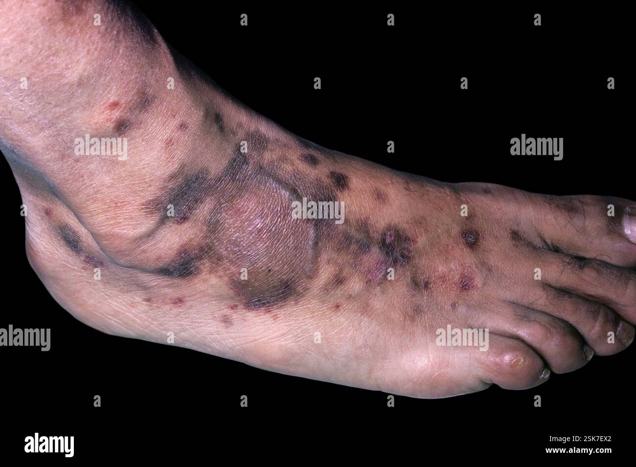 Pigmented purpuric dermatosis (PPD) on the foot of a 73 year old male ...