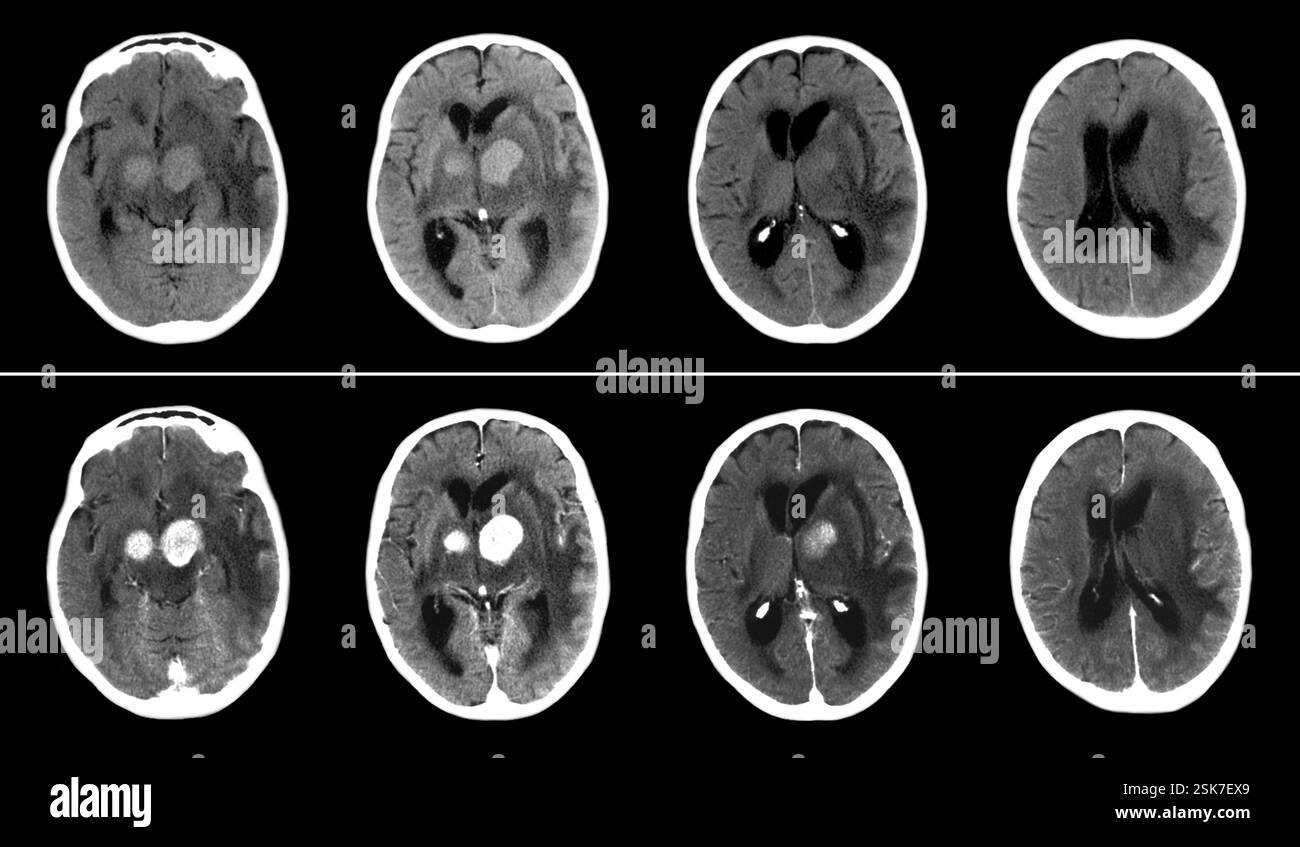 Cerebral lymphoma. Computerised tomography (CT) scans of the brain of a ...