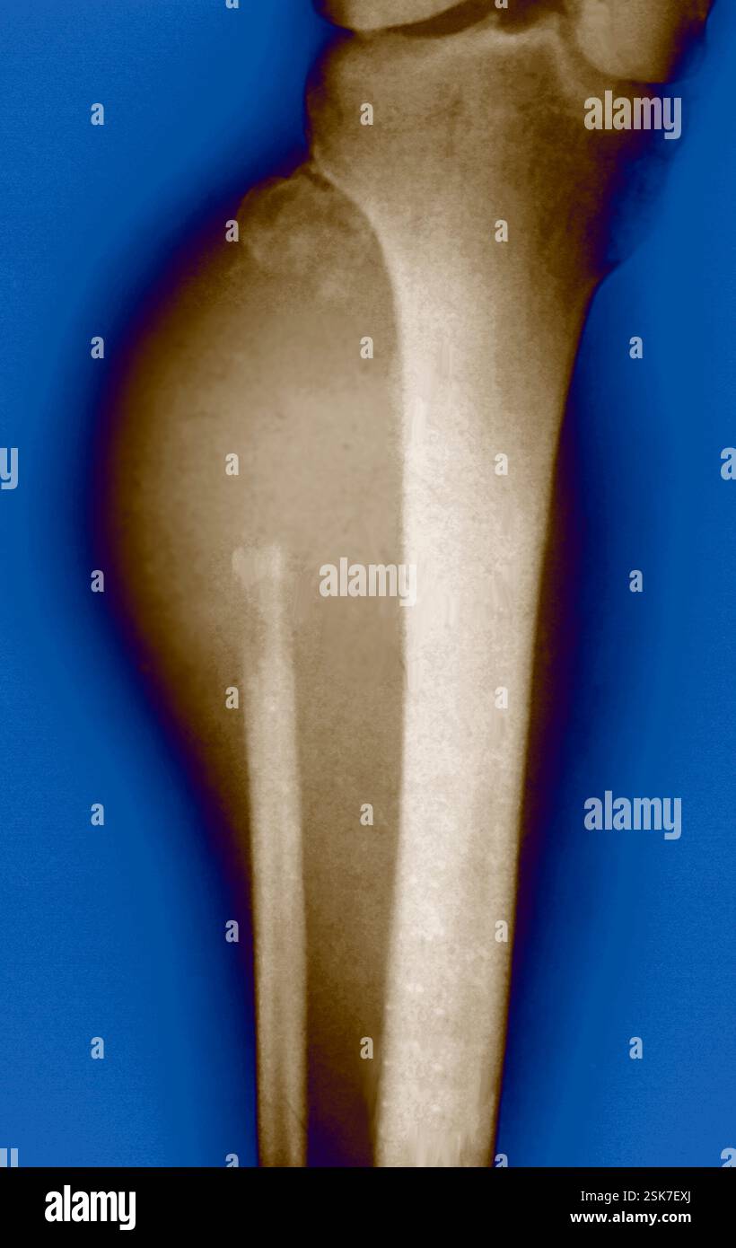 Bone cancer of the leg, X-ray. This cancer (osteosarcoma) has affected ...