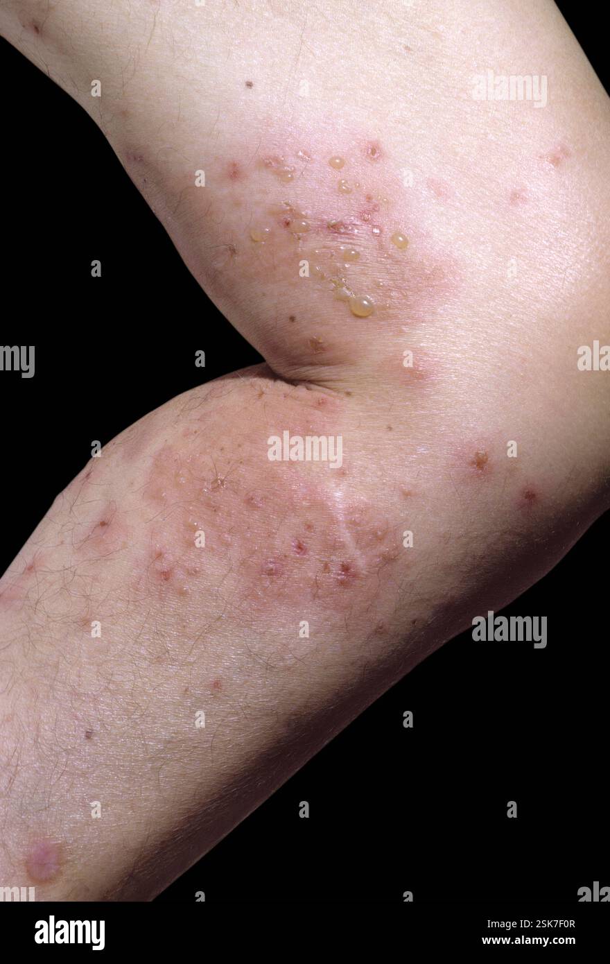 Dermatitis herpetiformis (DH, Duhring's disease) on the leg of a 40 ...