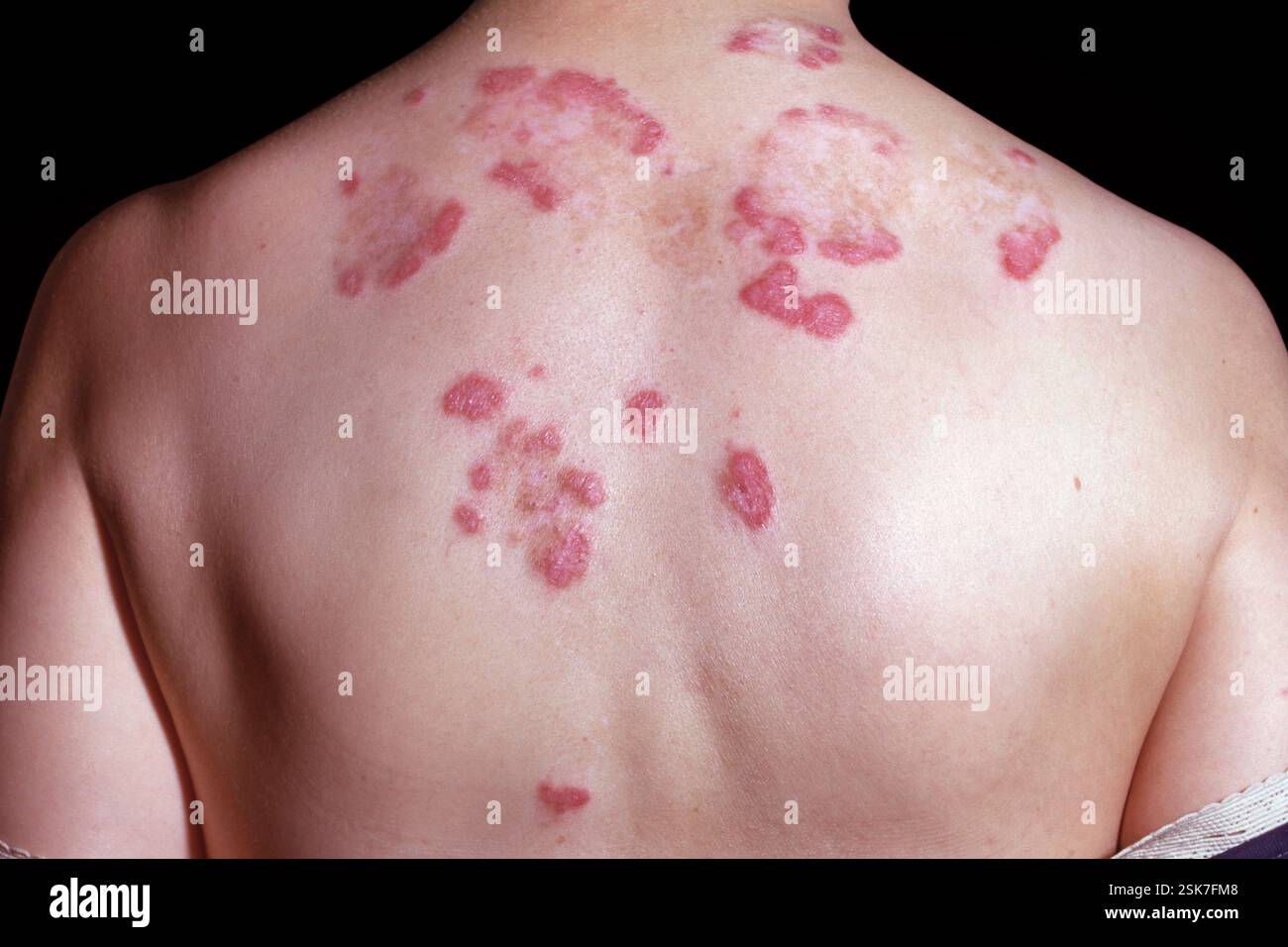 Discoid lupus erythematosus lesion on the back of a 50-year-old man ...