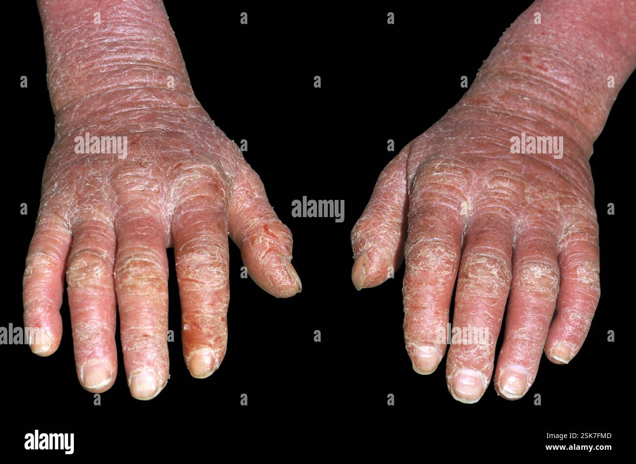 Erythrodermic (reddened) mycosis fungoides on the hands of a 42 year ...