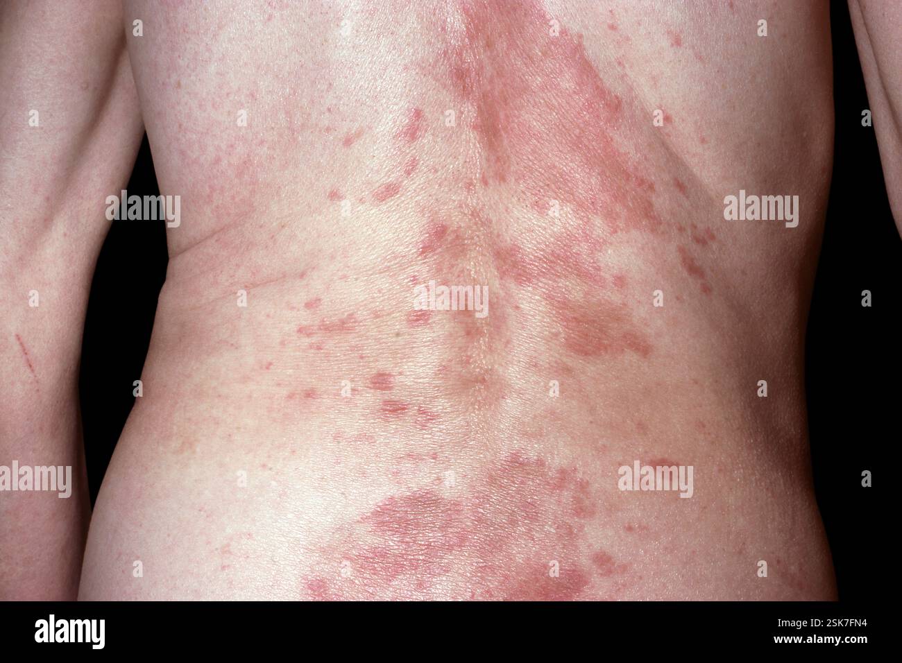 Plaque parapsoriasis lesions on the back of a 64-year-old male patient ...