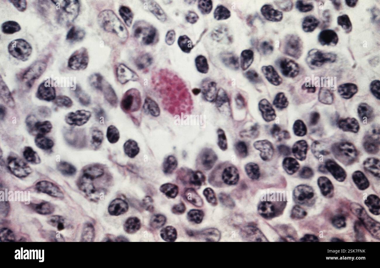 Cerebral toxoplasmosis. Histological section through the brain tissue ...