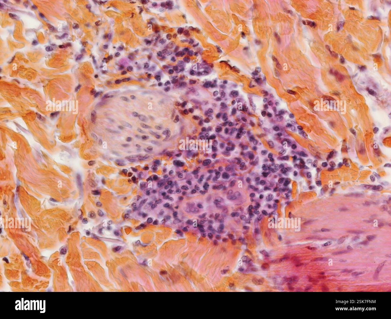 Pyogenic granuloma on a boy's lip Stock Photo - Alamy