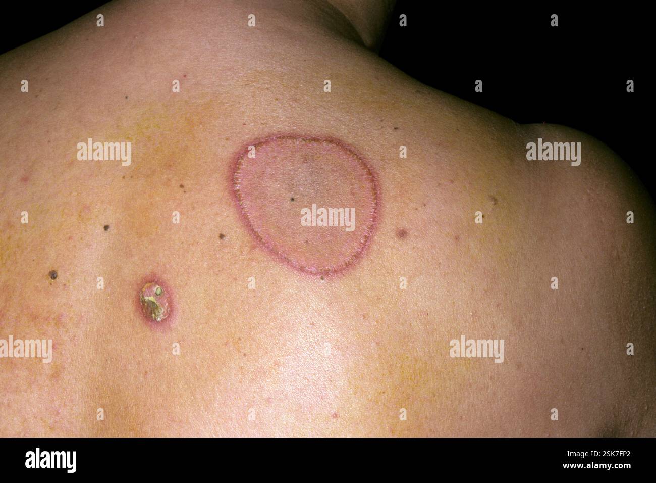 Lesions of fixed drug eruption on the back of a 32-year-old male ...