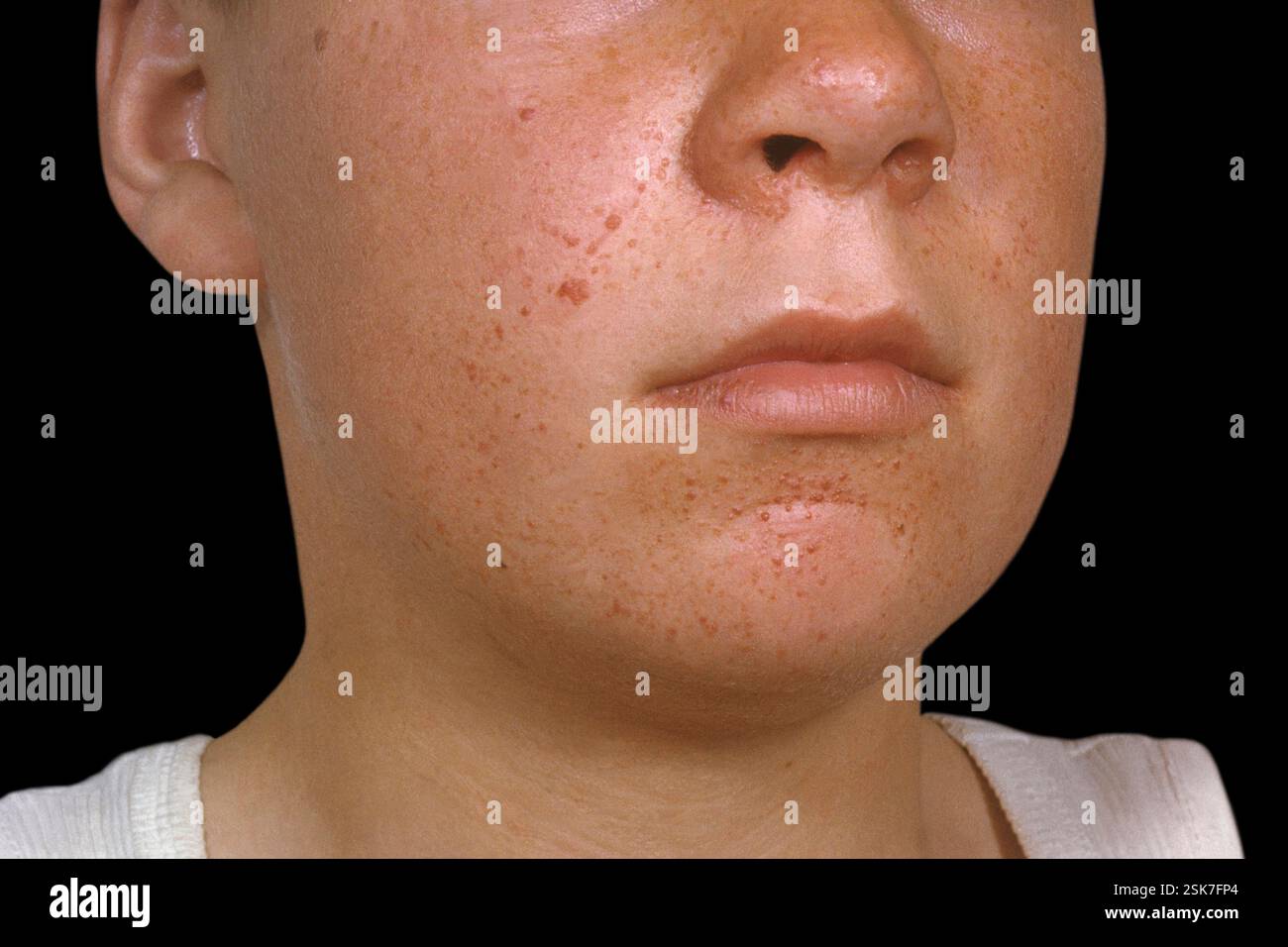Face of a boy with skin lesions (cutaneous angiofibromas) caused by ...