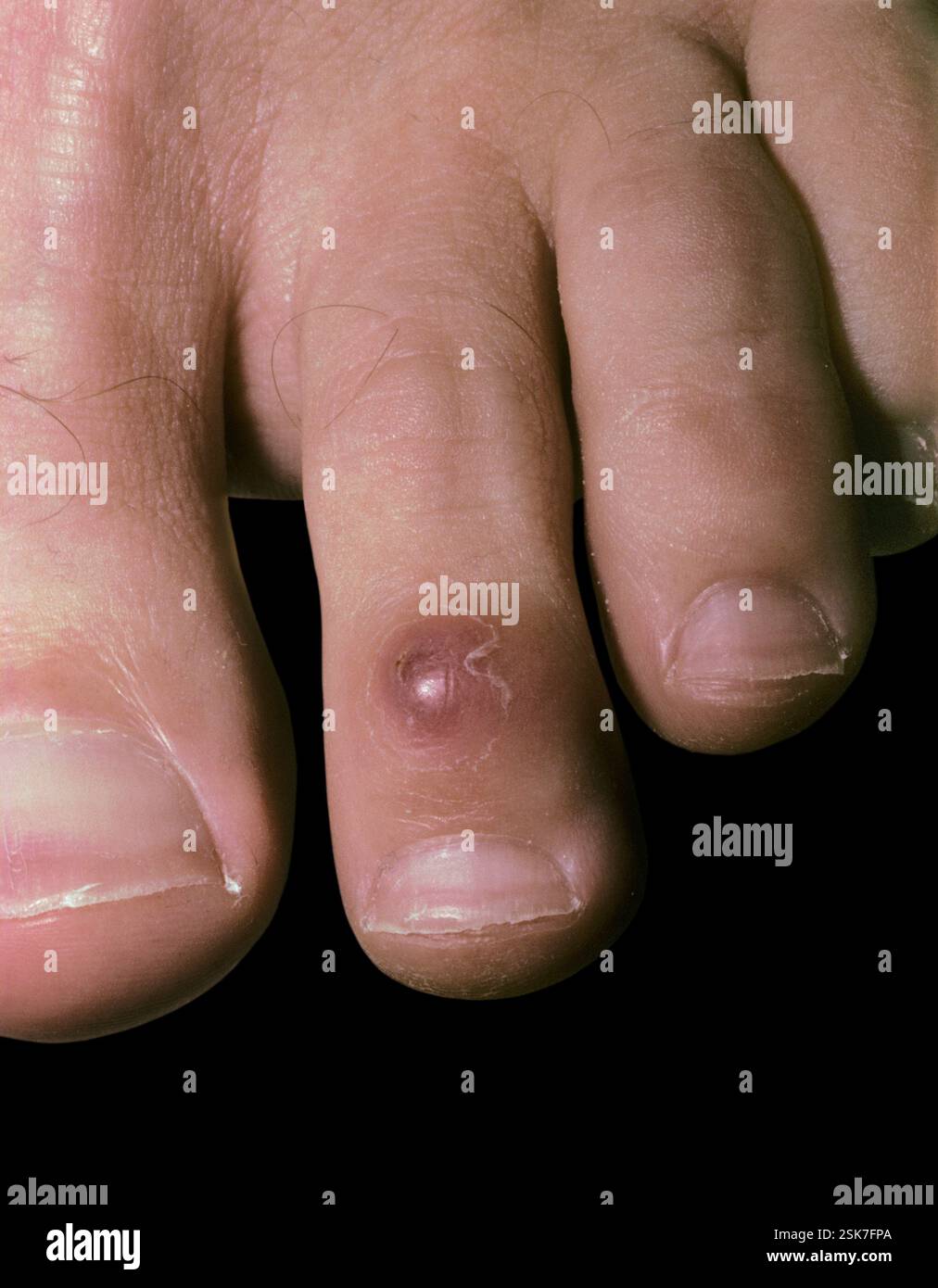 Myxoid pseudocyst. Close-up of a myxoid pseudocyst on the toe of a 32 ...