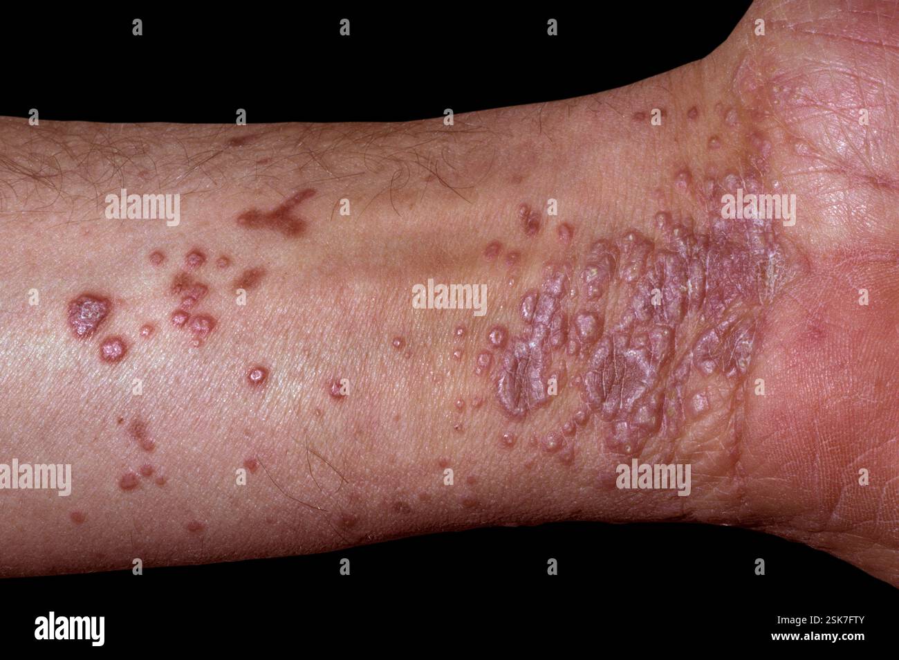 Lichen planus. Lesions on the wrist of a 43-year-old male patient with ...