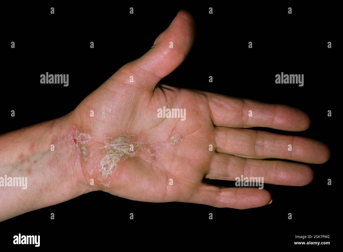 Lichen planus. Lesions on the hand of a 35-year-old male patient with ...