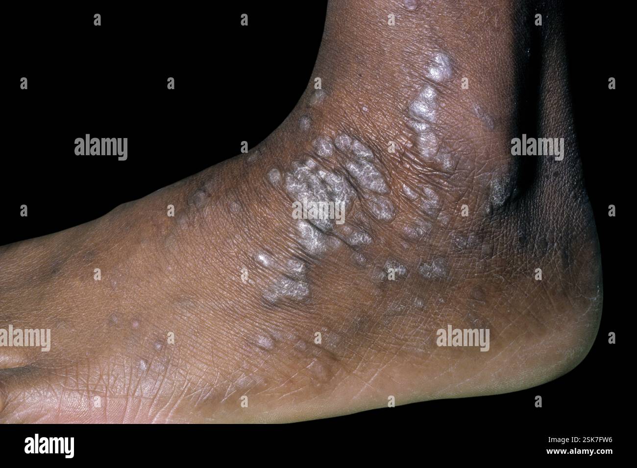 Lichen planus. Lesions on the foot of a 30-year-old black male patient ...
