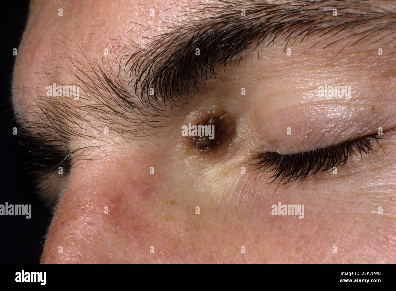 Eyelid mole. Dermal naevus (mole) on the eyelid of a 41-year-old male ...