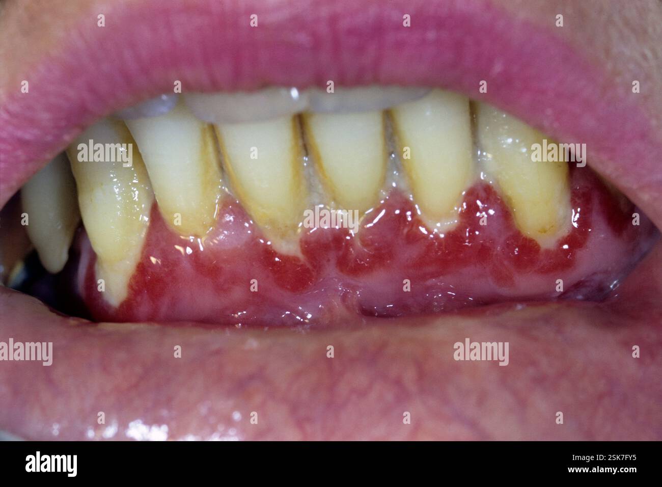 Pemphigus vulgaris. Close-up of the gums of a 61-year-old female ...