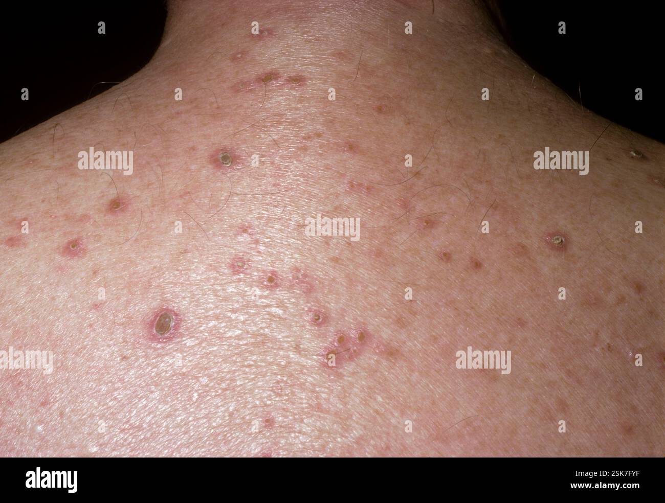 Prurigo nodularis. Lesions on the back of a female patient with nodular ...