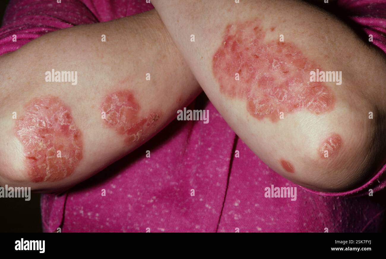 Psoriasis. Psoriasis on the arms of a 43-year-old female patient ...