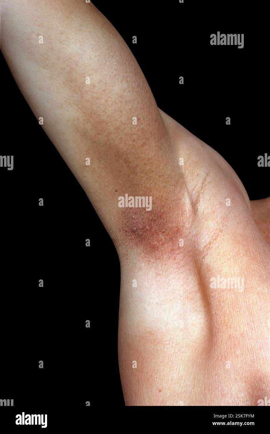 Parapsoriasis lichenoides skin lesions in the armpit of a 50-year-old ...