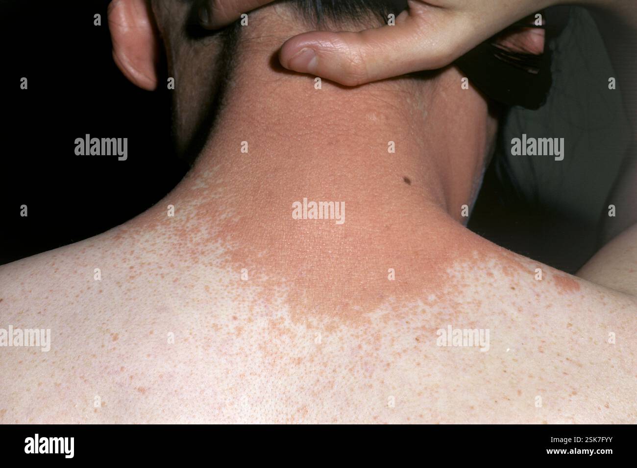 Pityriasis rubra pilaris. Pityriasis rubra pilaris on the neck of a ...