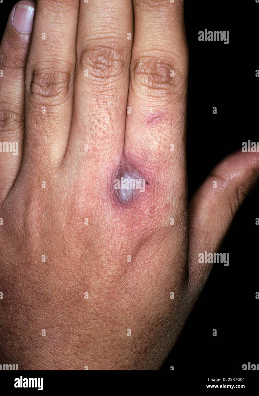 Cutaneous tuberculosis. Close-up of a lesion on the hand of a 46-year ...
