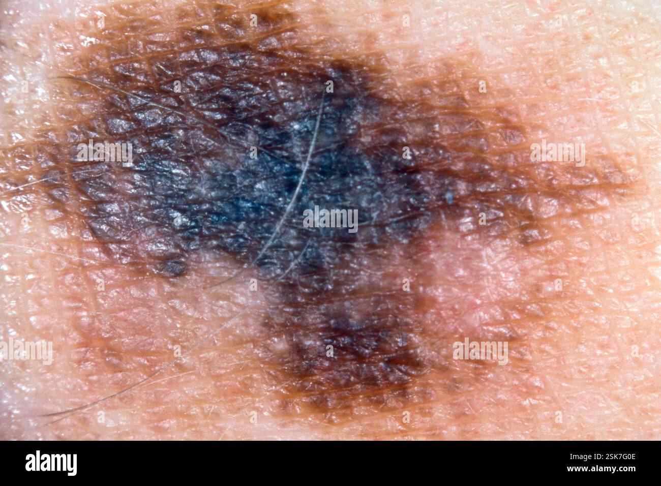 Erythrodermic mycosis fungoides on a man's body Stock Photo - Alamy