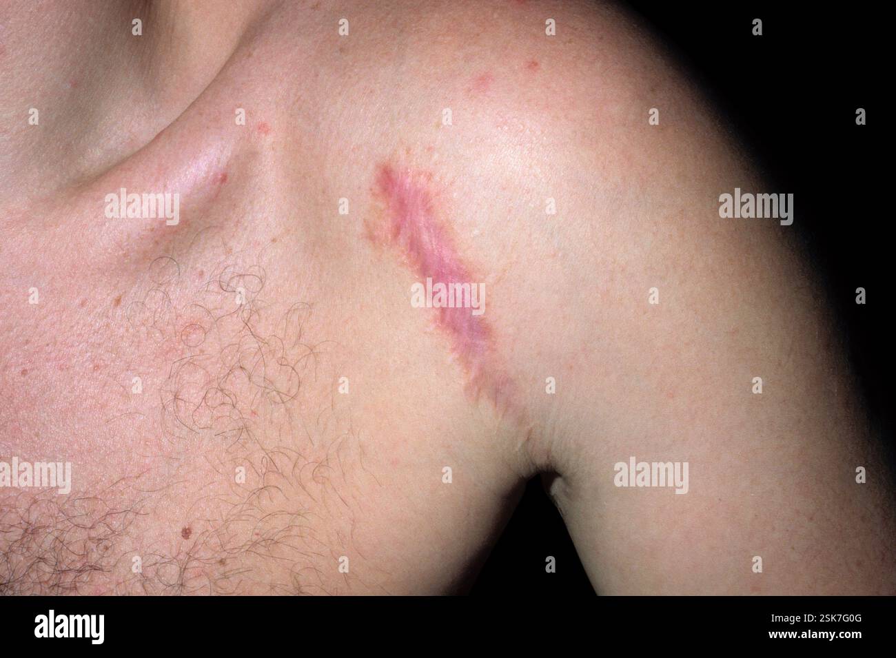 Hypertrophic scarring. Hypertrophic scar on the shoulder of a male ...