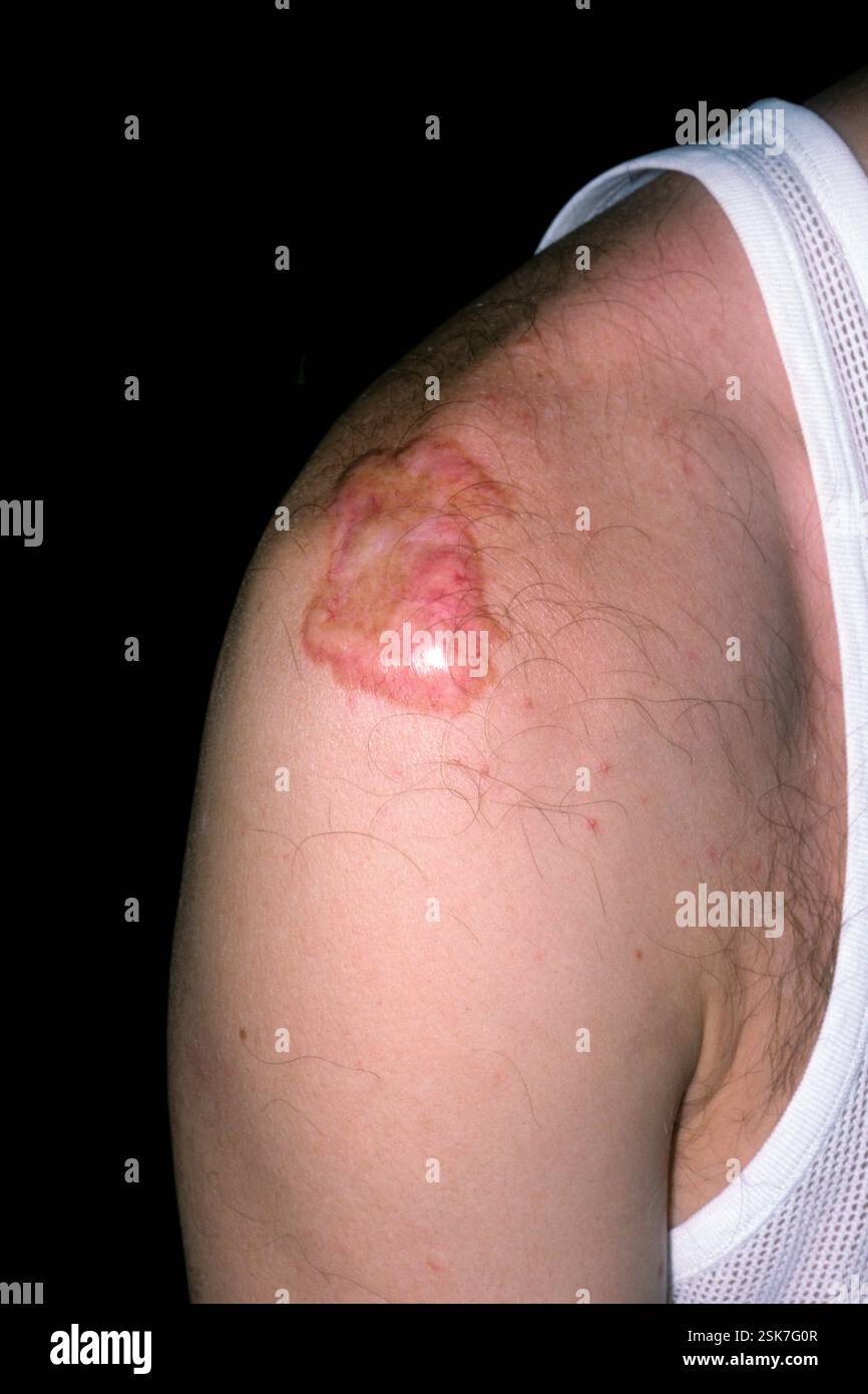 Keloid scar. Keloid scar on the shoulder of a male patient. A keloid ...