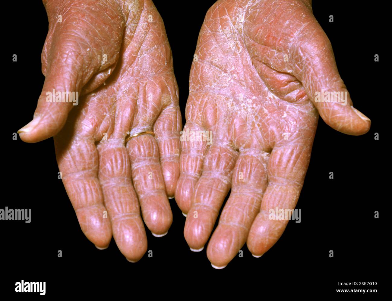 Mycosis fungoides palmaris et plantaris in a 75-year-old man. Mycosis ...