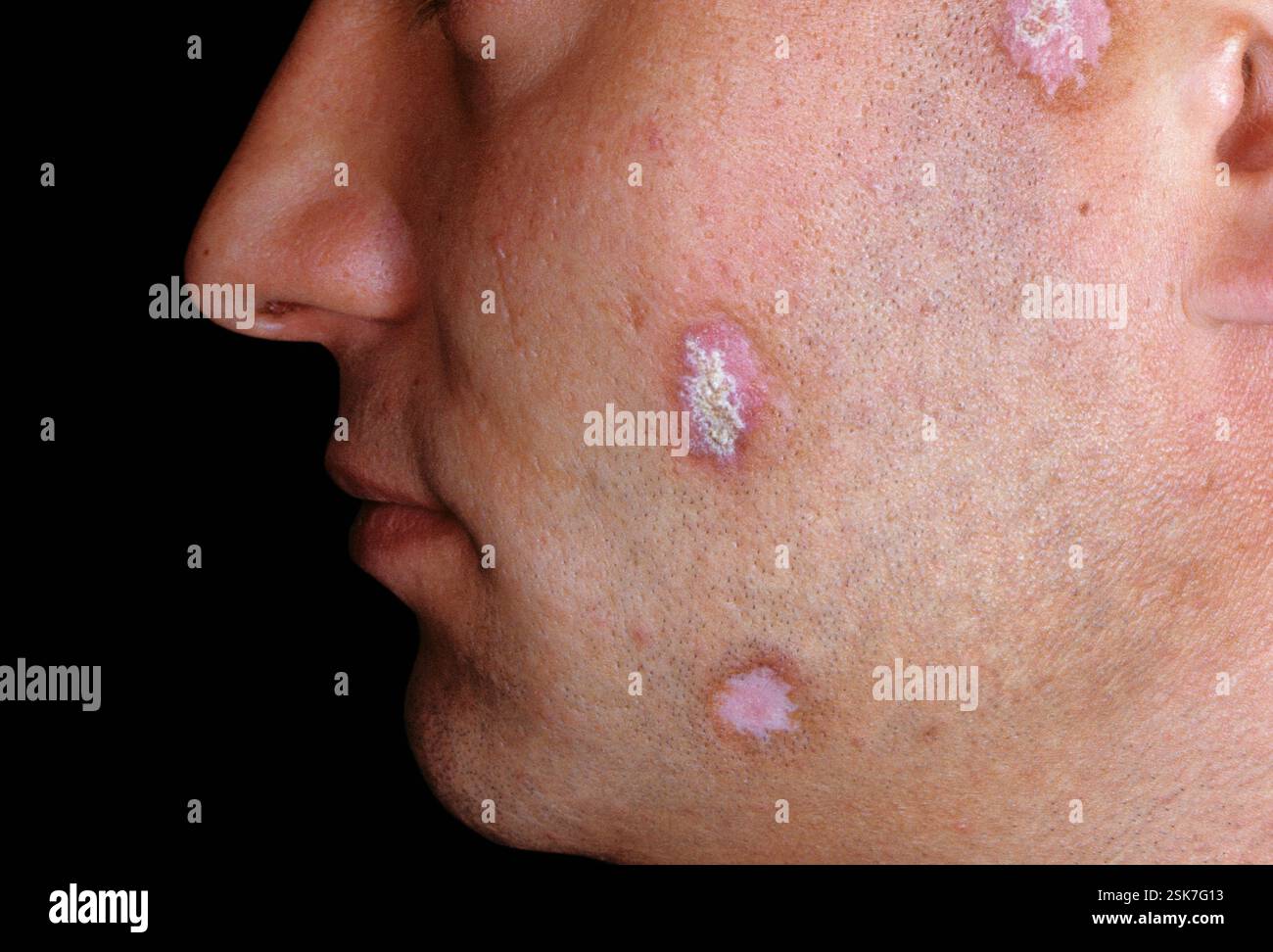 Discoid lupus erythematosus. Lesions on the face of a 34-year-old male ...