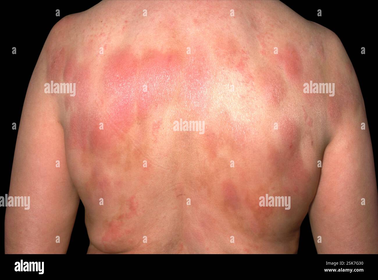 Sezary syndrome on the back of a 63-year-old woman. Sezary syndrome is a form of non-Hodgkin ...