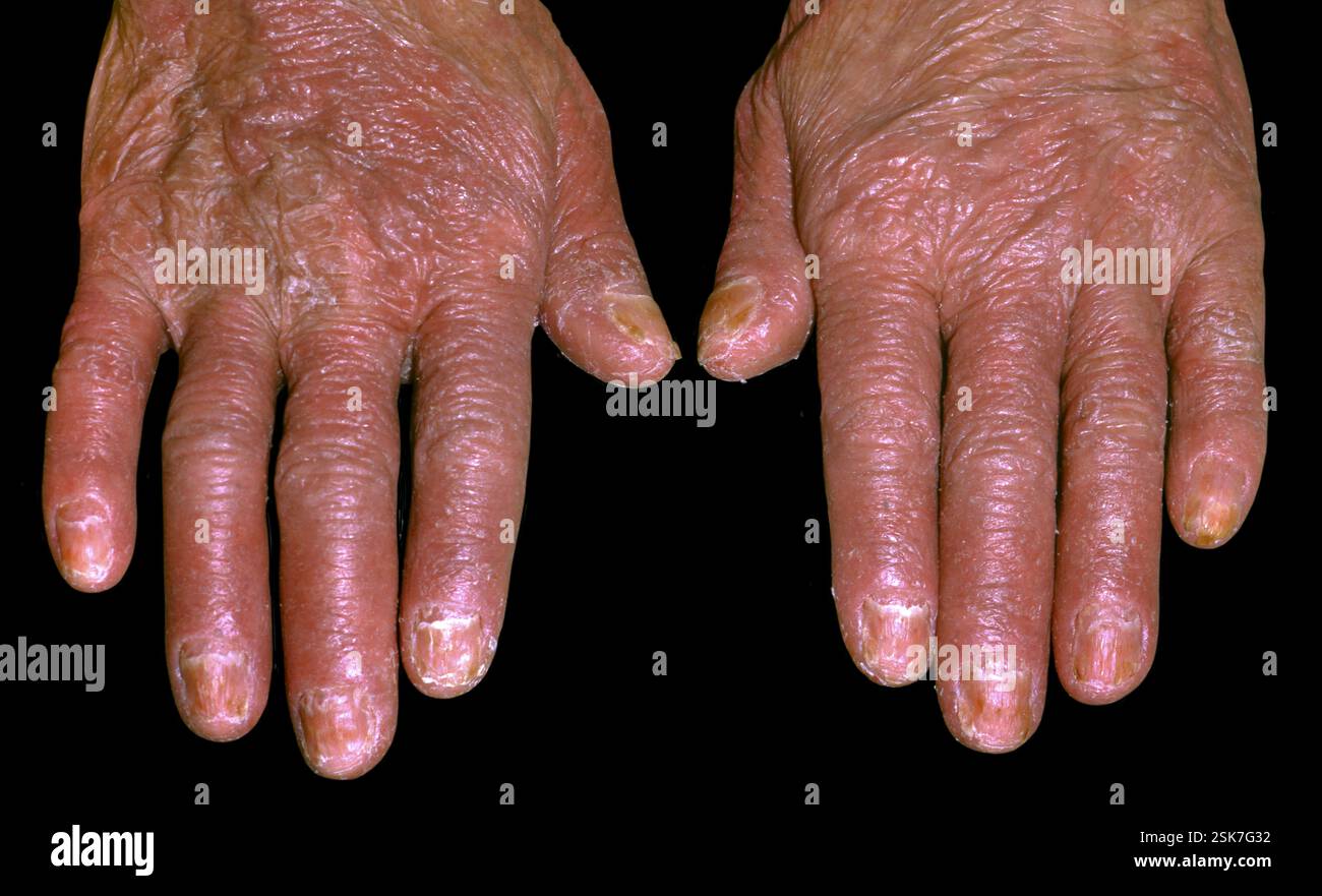 Sezary syndrome on the hands of a 76-year-old man. Sezary syndrome is a ...