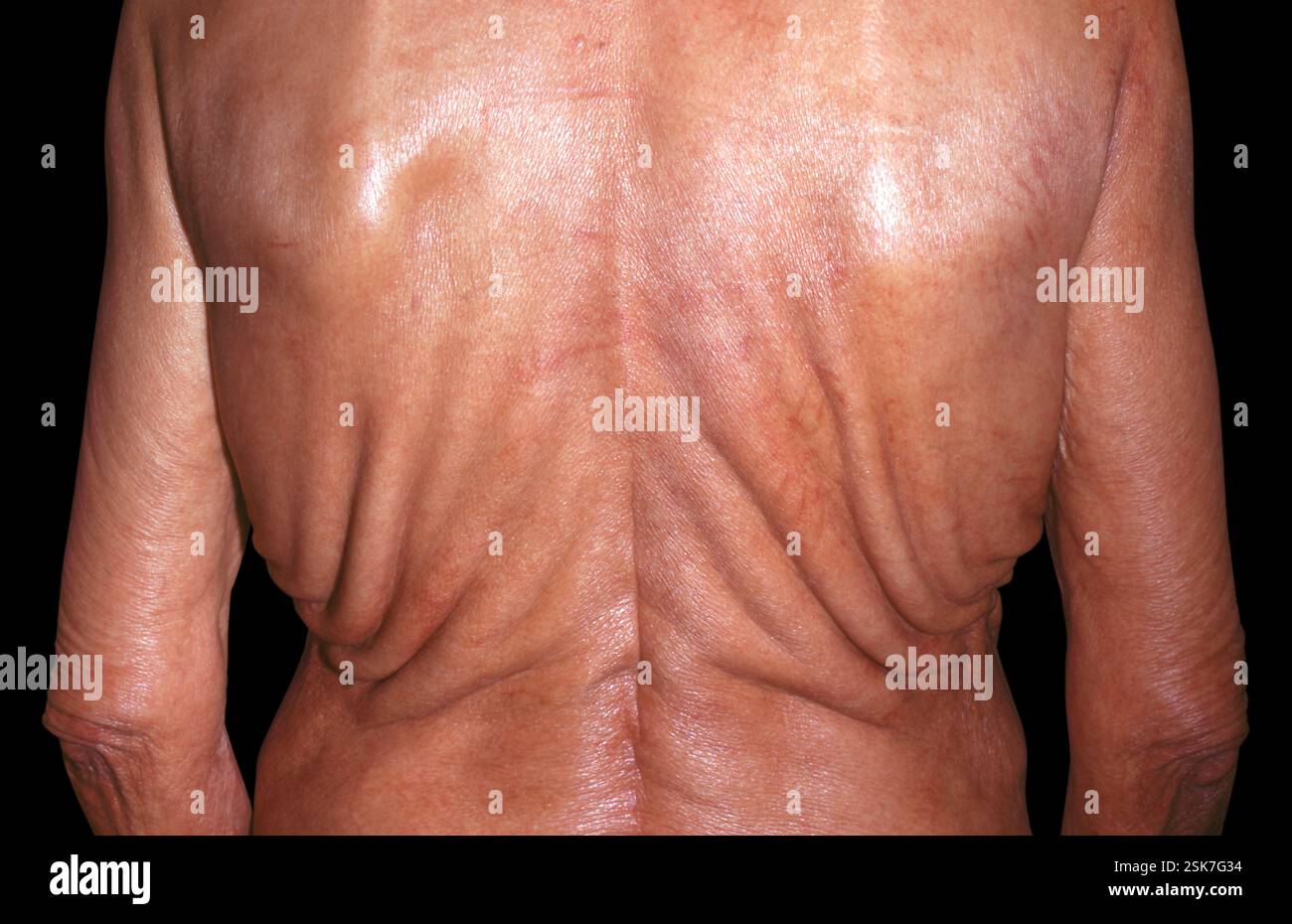 Sezary syndrome on the back of a 75-year-old man. Sezary syndrome is a form of non-Hodgkin ...