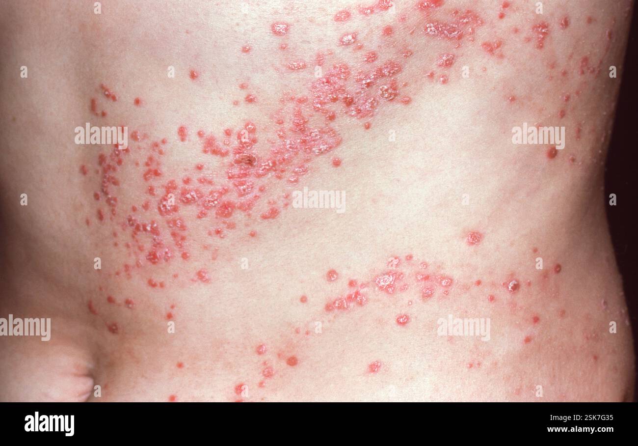 Guttate psoriasis on the abdomen of a 25-year-old man. Guttate ...