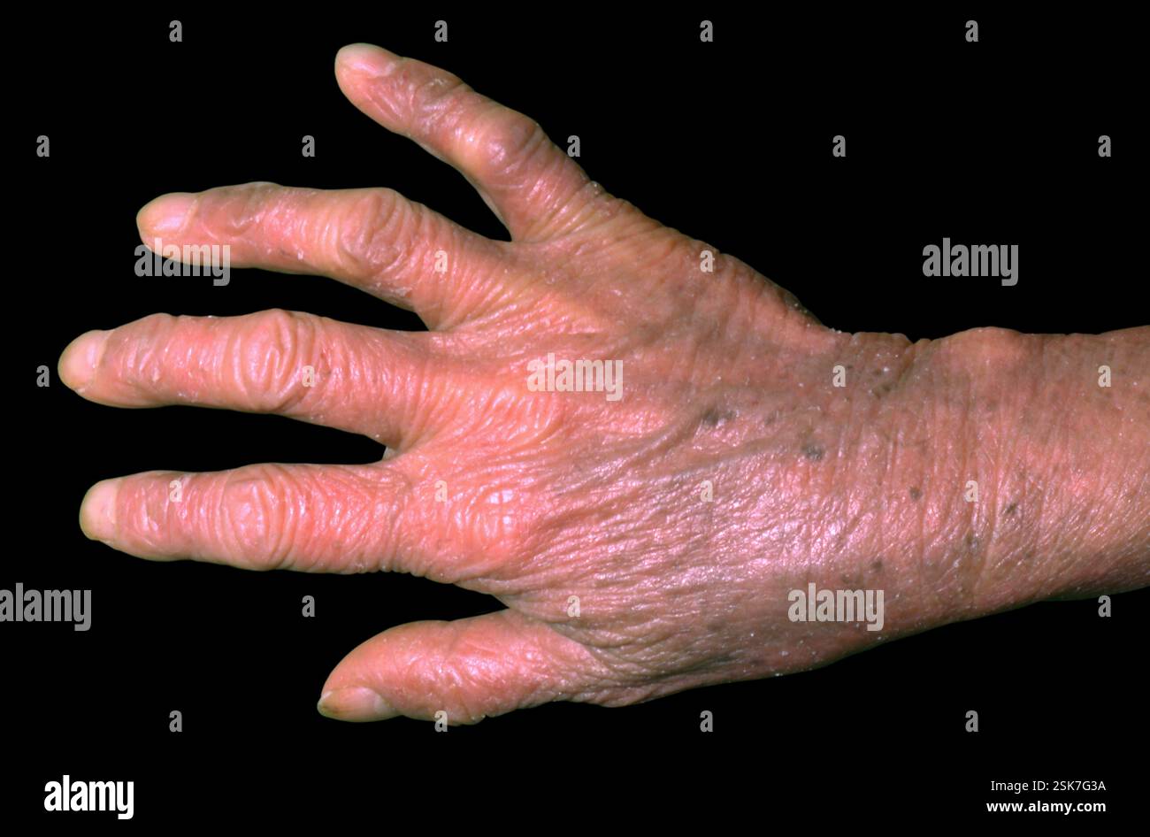Sezary syndrome on the hand of a 75-year-old woman. Sezary syndrome is ...