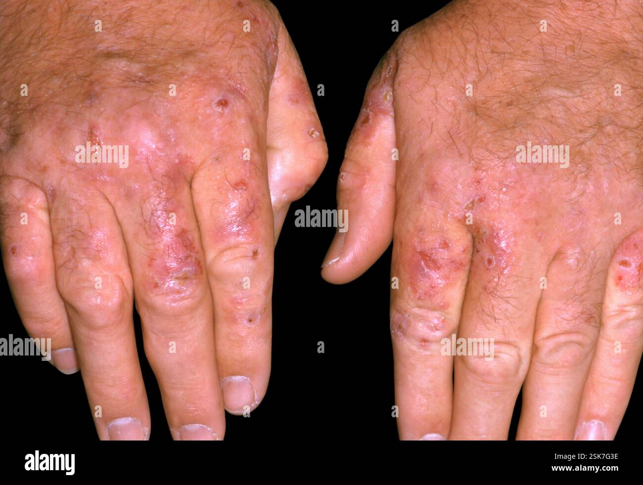 Congenital ichthyosiform erythroderma Stock Photo - Alamy