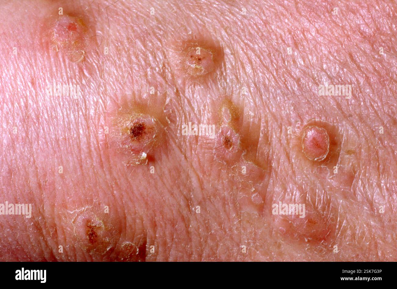 Nodular prurigo on the hand of a 64 year old female patient. This ...