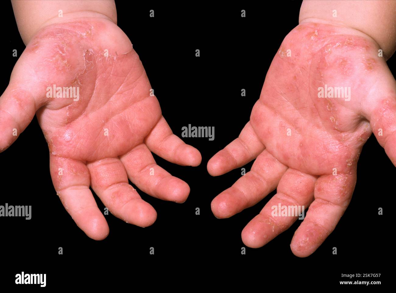 Atopic eczema on the hands of a young female patient. Atopic eczema ...