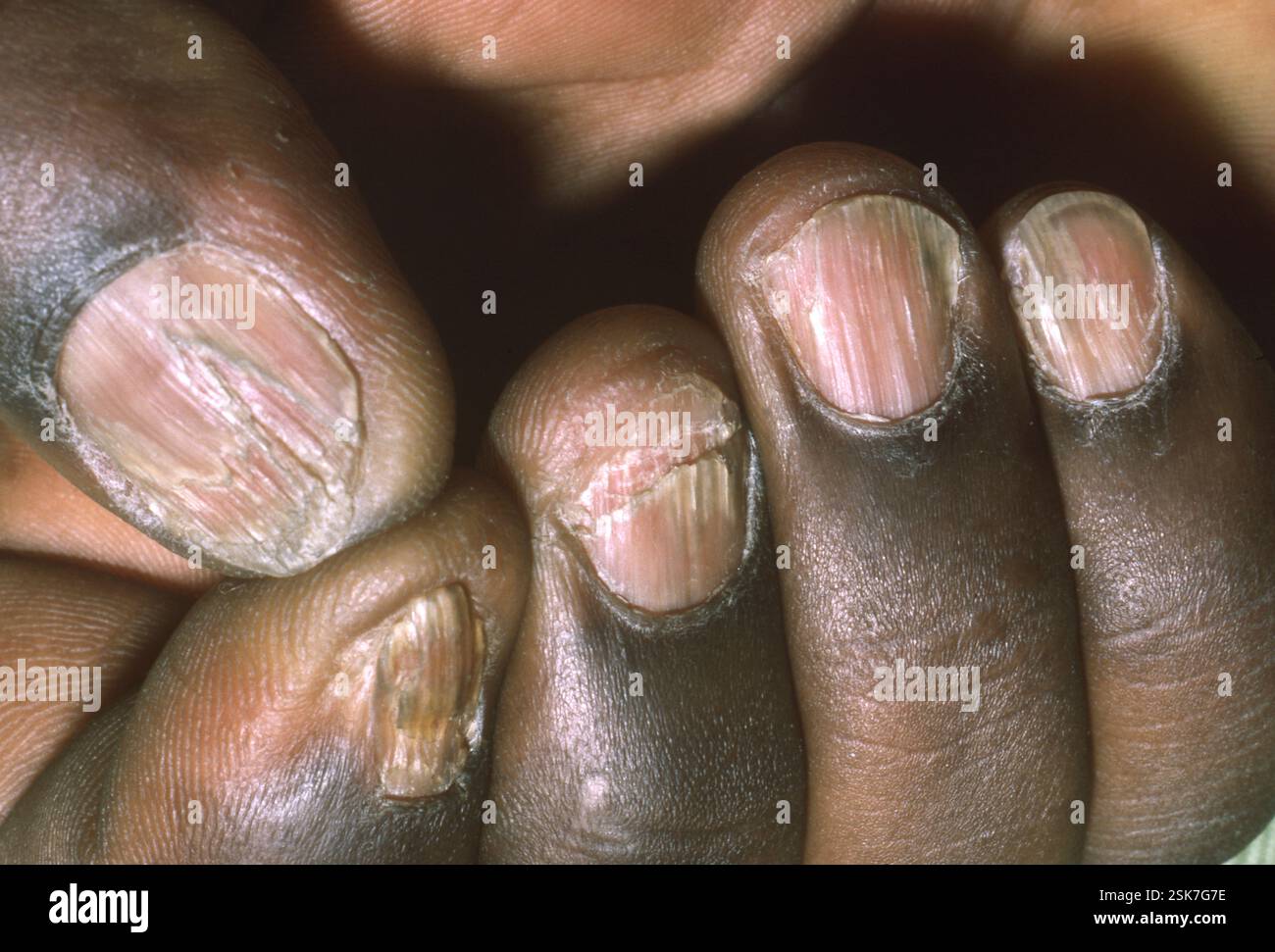 Fingernails with lichen planus disease on a male patient. This is a ...