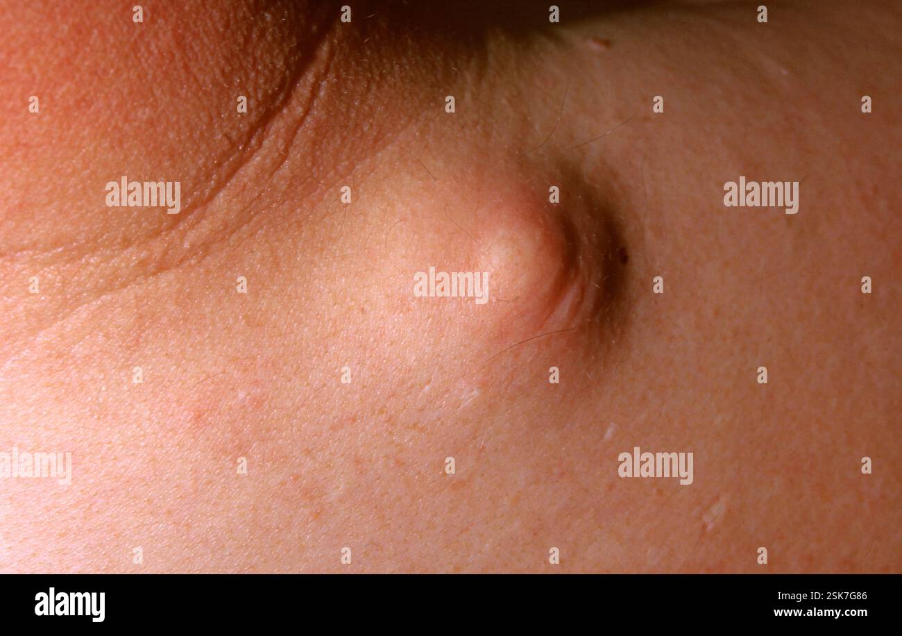 Lipoma on the neck of a female patient. A lipoma is a benign (non ...