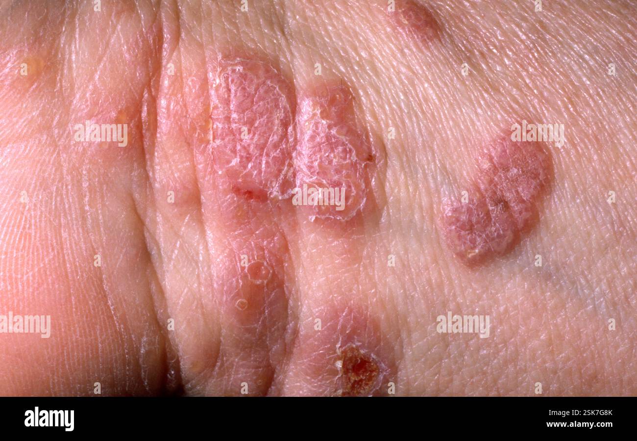 Lichen planus disease on a female patient's wrist. Lichen planus is an ...