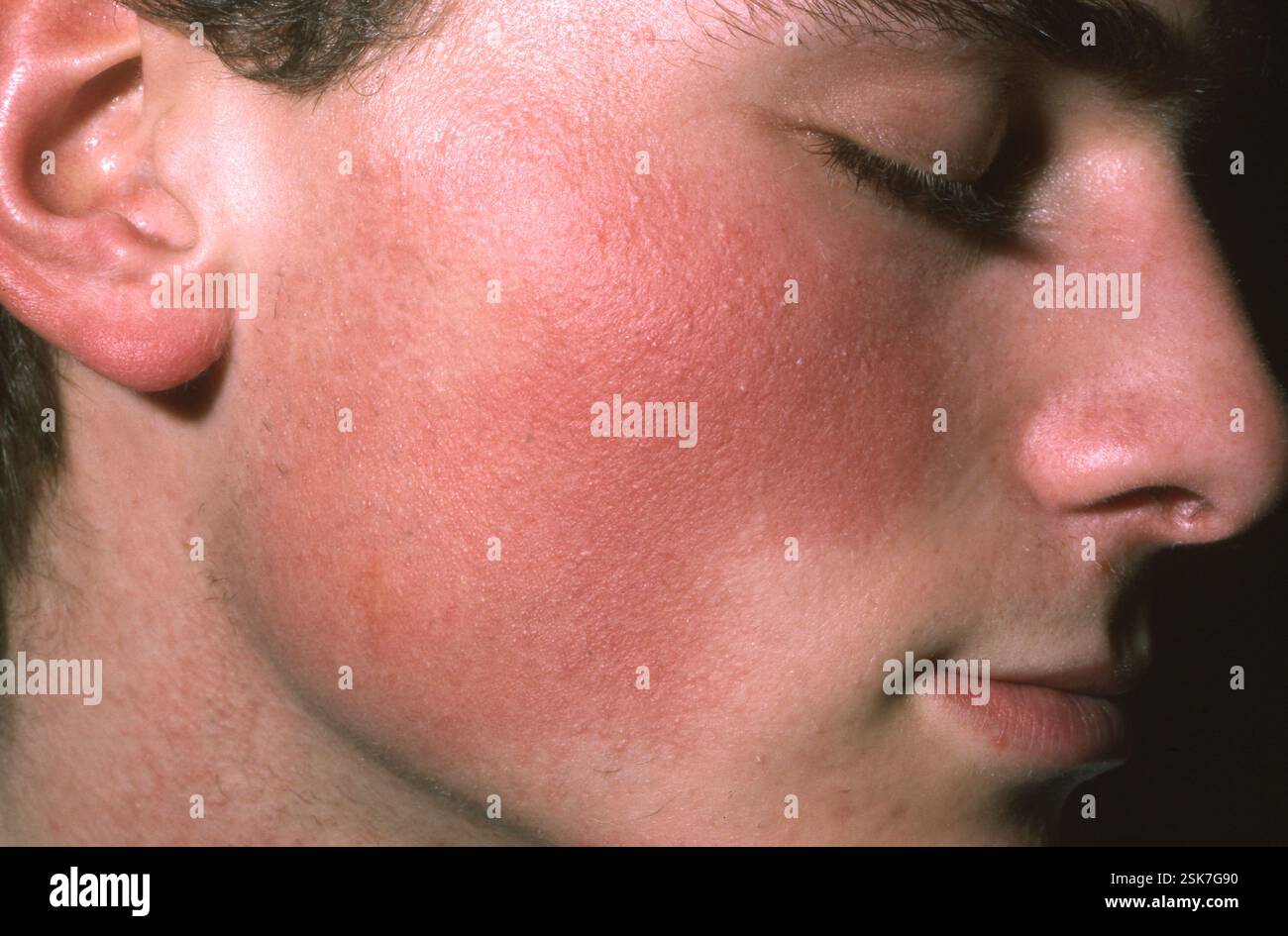 Rash on the face of a male patient with keratosis pilaris. This genetic ...