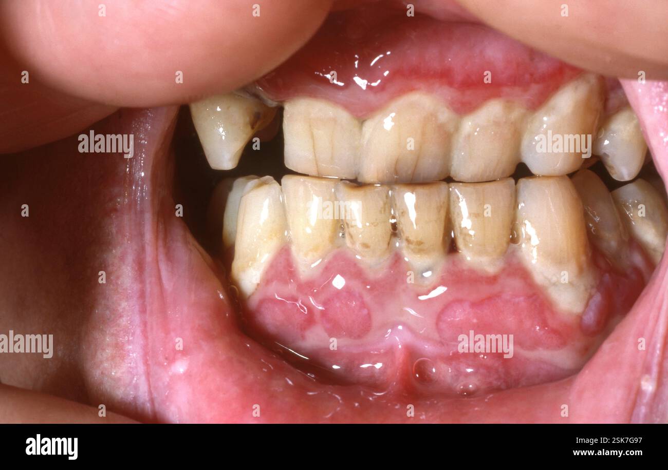 Blisters on the gums of a male patient in a case of bullous pemphigoid ...
