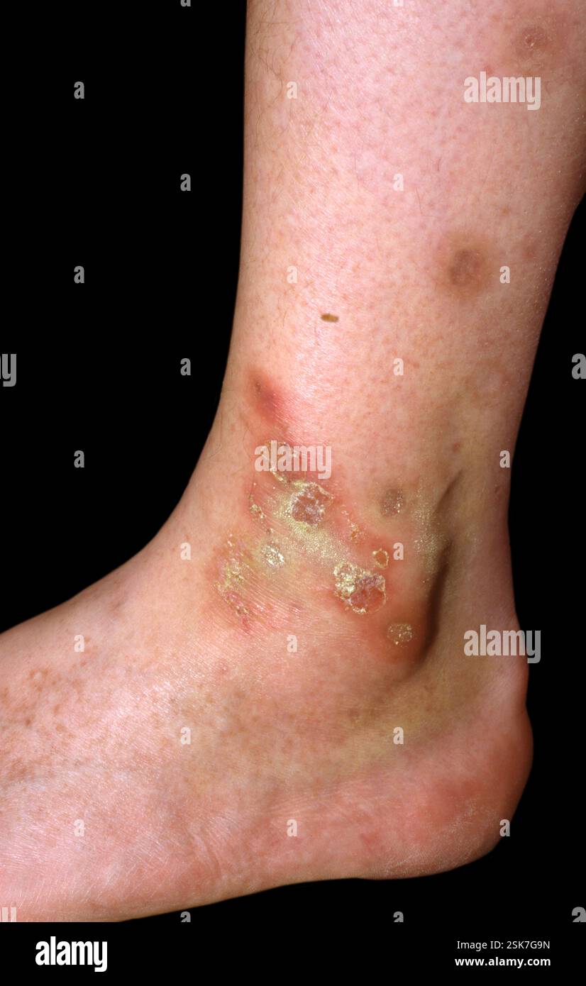 Lesions on the ankle of a diabetic female patient caused by necrobiosis ...