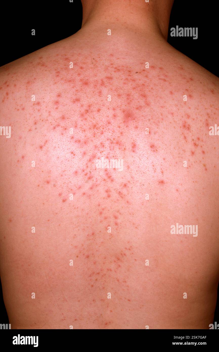 Prickly heat rash, also known as sudamina, on the back of a male ...