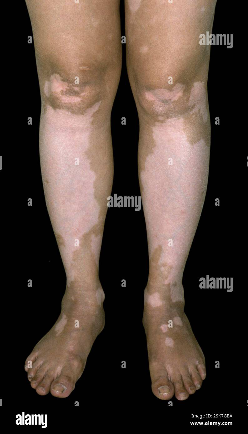 Monoclonal immunoglobulin deposition disease, light micrograph Stock ...