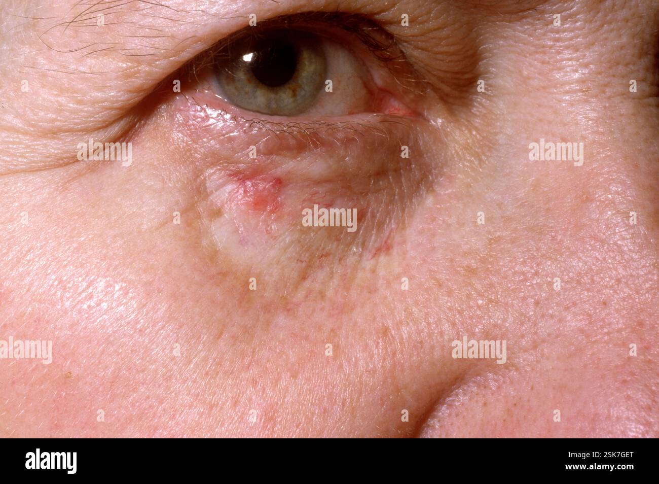 Radiation dermatitis on the lower eyelid of a 50 year old female ...