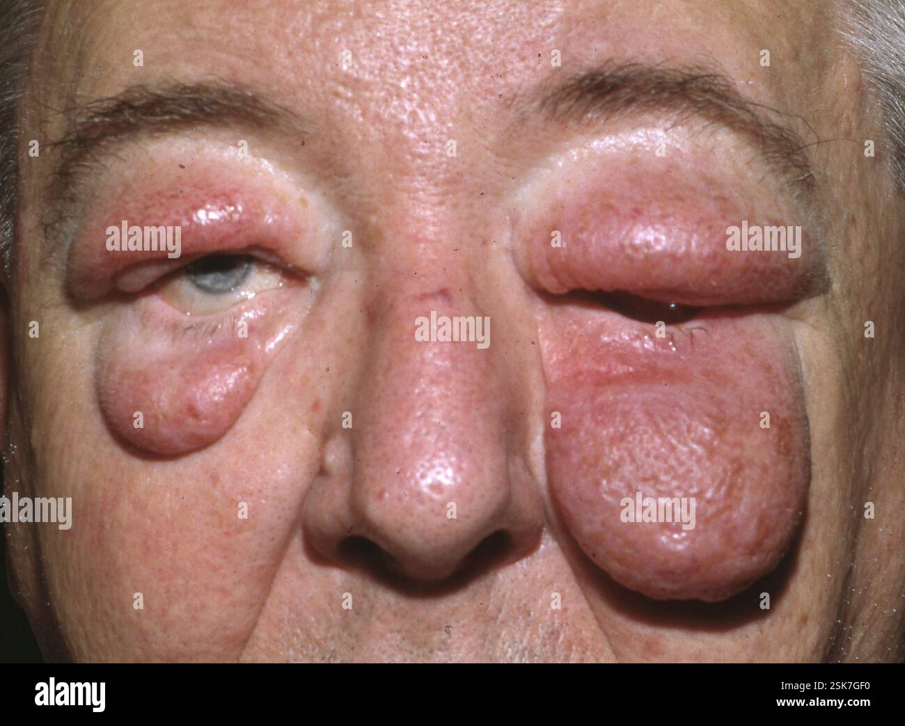 Ascher's syndrome (blepharochalasis) in a 70-year-old man. Ascher's ...