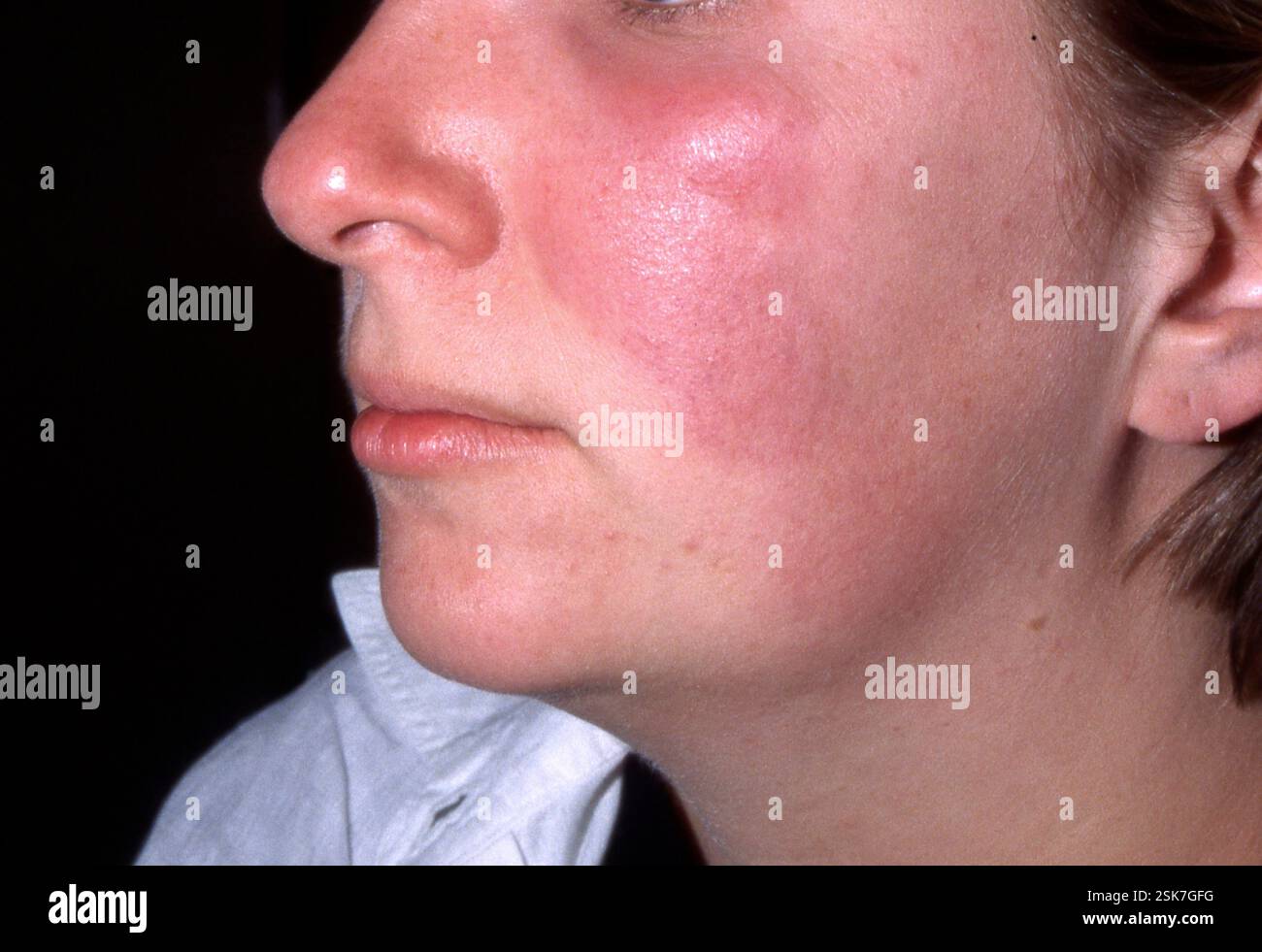 Reddened skin on the face of a 30 year old female patient with ...